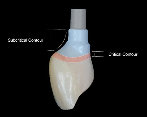 News - Soft tissue contour management of implant-supported restorations ...