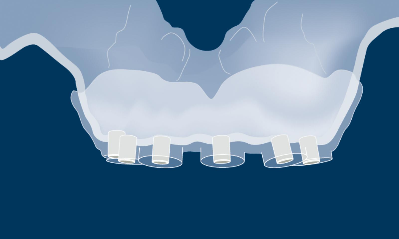 Articles - Forum Implantologicum - ITI