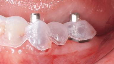 Replacement of Multiple Teeth in a Partially Dentate Posterior Mandible with a Fixed Dental ...