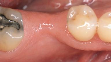 Soft-Tissue Volume Augmentation Using a Connective-Tissue Graft ...