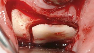 Combined SFE and Horizontal Ridge Augmentation with Autologous Block ...