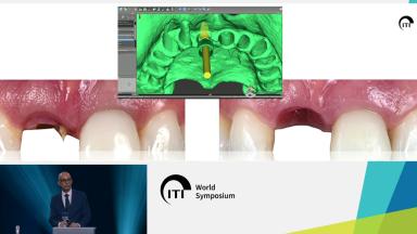 WS2024 - Post-extraction Ridge Alterations – Assessment of Bone ...