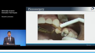 Minimally Invasive Extraction Techniques - Congress Lectures - ITI