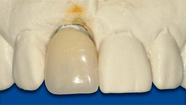 Design Principles for Implant-Supported Provisional Prostheses ...