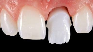 Immediate Implant Placement to Replace a Fractured Central Incisor in a ...