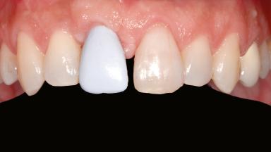 Staged GBR with Allogeneic Particulate Grafting Material for Single ...