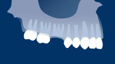 Healing of the Extraction Socket - Learning Modules - Home - ITI