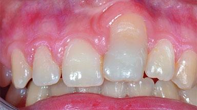 Replacement of an Ankylosed Central Incisor with a Gingival Recession ...