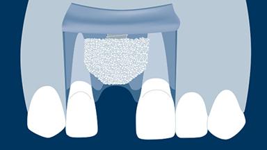 Principles of Guided Bone Regeneration (GBR) - Assessments - Home - ITI