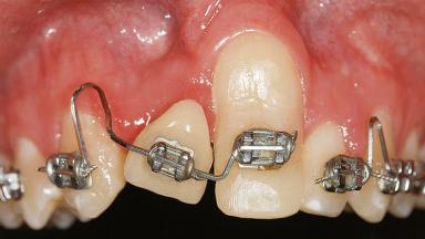 Soft- and Hard-Tissue Regeneration and Implant-Supported Restorations ...