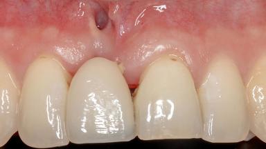 Soft-Tissue Augmentation Using a Porcine-Derived Collagen Matrix to ...