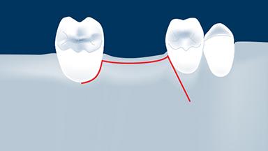 Flap Design - Learning Modules - Academy - ITI