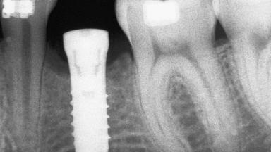 Autologous Block Graft and Guided Bone Regeneration (GBR) for ...
