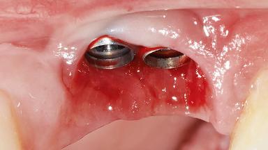 GBR and Soft-Tissue Augmentation Following Explantation to Rehabilitate ...