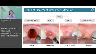 Post-Extraction Implant Placement: When Immediate, When Early and When Late? - Congress Lectures ...