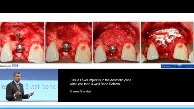 Tissue Level Implants in the Esthetic Zone with Less than 3-wall Bone ...