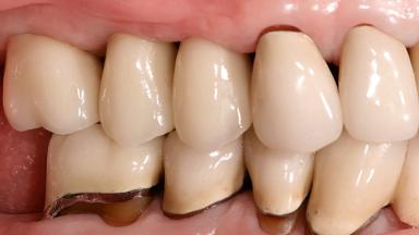 Replacement of Multiple Teeth in a Partially Dentate Posterior Maxilla with Crowns Using a ...