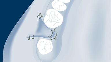 Flap Closure - Assessments - Home - ITI