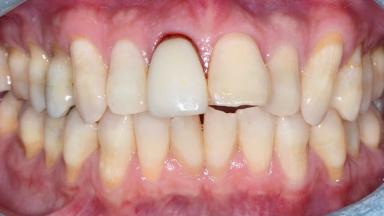 Soft Tissue Augmentation before Implant Placement in an Area of High ...