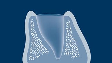 Ridge Preservation Techniques - Learning Modules - Home - ITI