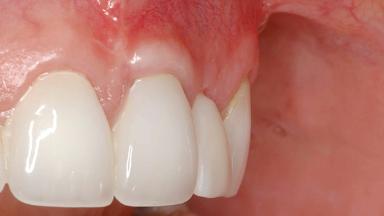 Connective-Tissue Graft to Augment the Buccal Tissue for a Bone-Level ...
