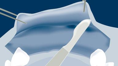 Periosteal Releasing Incision (PRI) - Learning Modules - Home - ITI