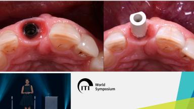 WS2024 - Prosthetic Considerations for Immediate Implant Placement and Loading - Congress ...
