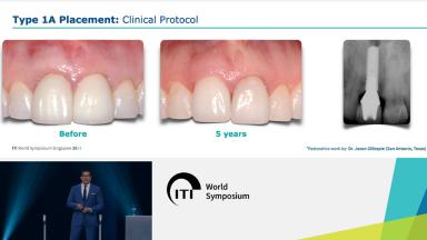 WS2024 - Soft Tissue Considerations for Immediate Implant Placement and Loading - Congress ...