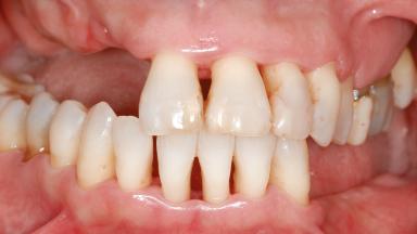 Shell Technique for Horizontal and Vertical Maxillary Bone Augmentation ...