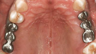 Replacement of Multiple Teeth in a Partially Dentate Posterior Maxilla and Mandible with Fixed ...