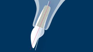 Timing of Implant Placement after Tooth Extraction - Assessments - Home ...