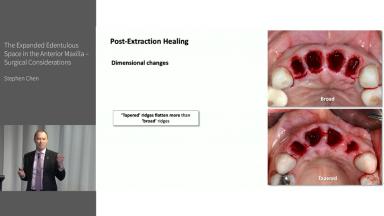 The Expanded Edentulous Space in the Anterior Maxilla – Surgical ...