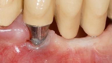 Covering a Soft-Tissue Dehiscence at a Mandibular Incisor - Clinical ...