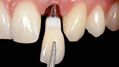 Immediate Implant Placement and Immediate Provisionalization with a Prefabricated-Shell ...