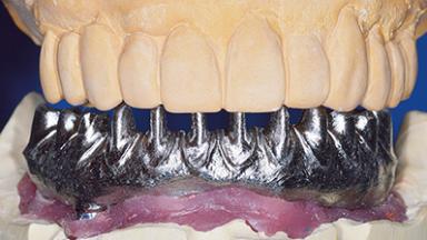 Replacing a Mandibular Denture with a Full-Arch Implant-Supported ...