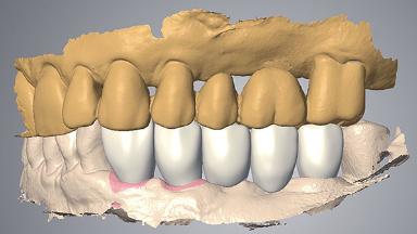 Replacing Three Mandibular Posterior Teeth with an Immediately Loaded ...
