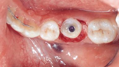 Replacement of an Endodontically Compromised Mandibular Left First ...