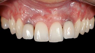 Periodontal Plastic Surgery and Prosthetic Procedures to Treat Peri ...