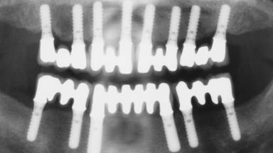 Immediate Loading of Eight Implants in the Maxilla and Six Implants in ...