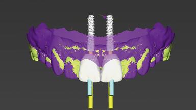 Immediate Implant Placement with Static Computer-Aided Implant Surgery ...