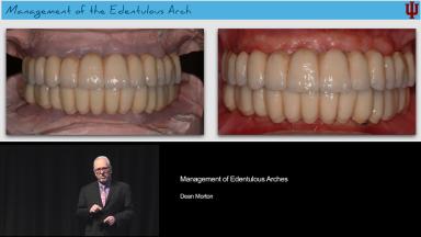 Management of Edentulous Arches - Congress Lectures - Home - ITI