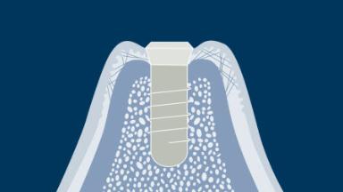 Tissue Integration of Dental Implants - Learning Modules - ITI