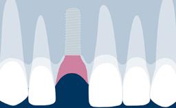 Periosteal Releasing Incision (PRI) - Learning Modules - Home - ITI