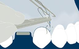 Periosteal Releasing Incision (PRI) - Learning Modules - Home - ITI