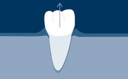 Ridge Preservation Techniques - Learning Modules - Home - ITI