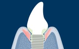 My ITI - Lisa J A Heitz-Mayfield - ITI